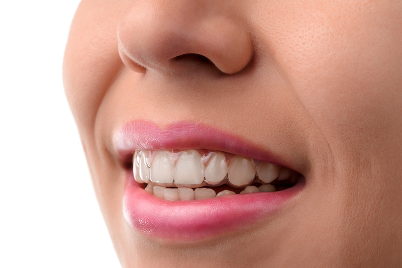 Invisalign Orthodontics in NYC Manhattan NY