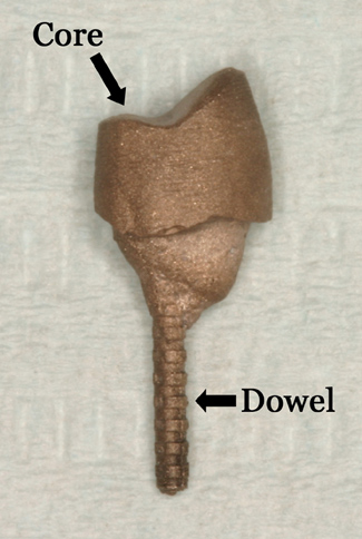 Posts (Dowel) and Cores | Prosthodontists Manhattan | Schweitzer ...
