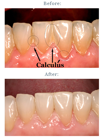 Tartar (calculus) | Prosthodontists Manhattan | Schweitzer & Schweitzer, PC